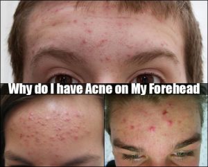 CAUSES FOR ACNE ON FOREHEAD - Whydoihaveacne.com